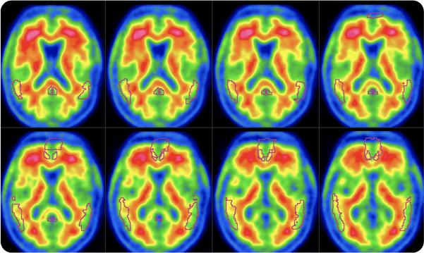 MIMneuro® | Visualize the Difference in Brain Analysis