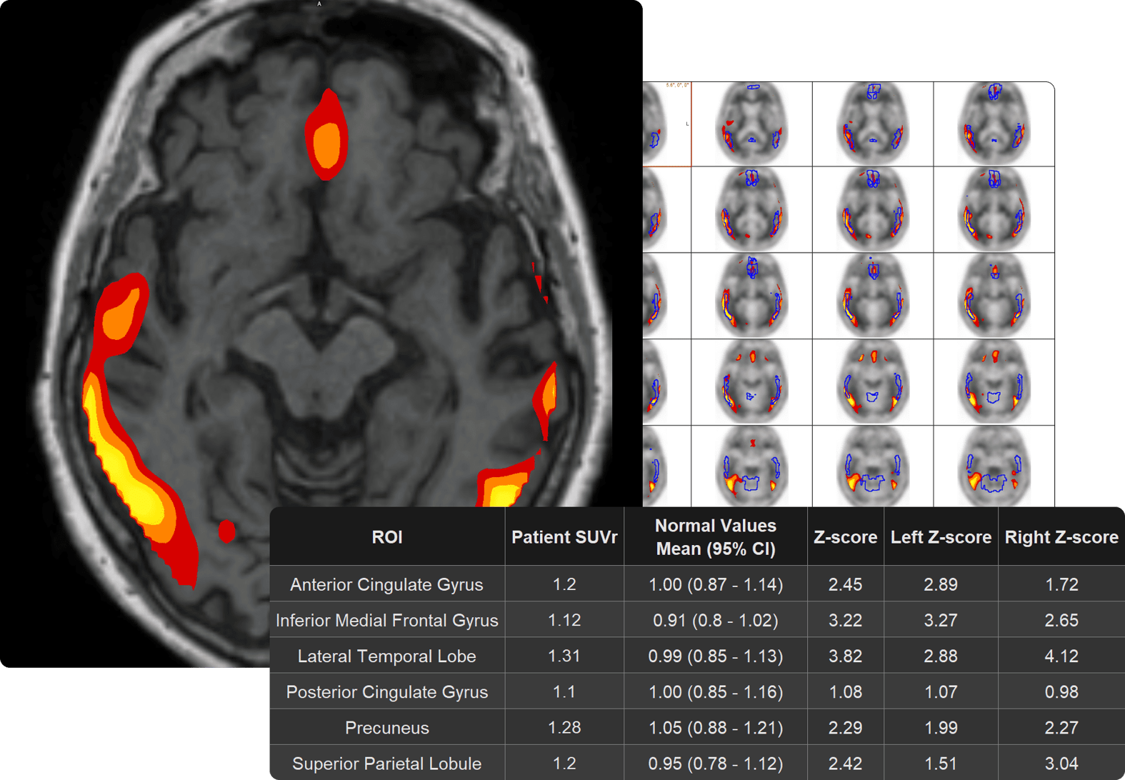 MIMneuro® | Visualize the Difference in Brain Analysis
